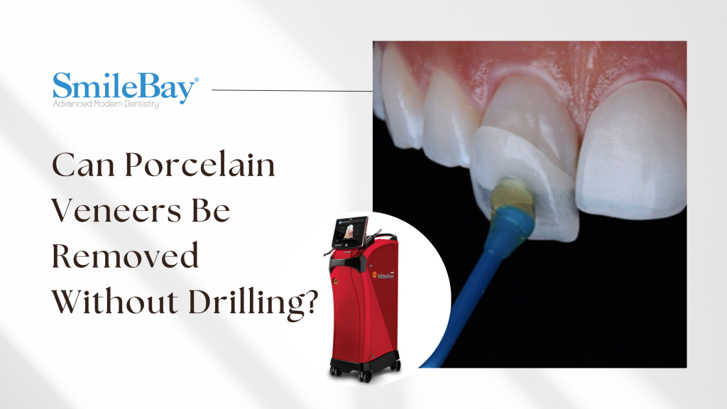 Can Porcelain Veneers Be Removed Without Drilling?